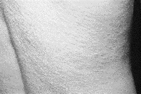 Treatment Of Primary Anetoderma With Colchicine Journal Of The American Academy Of Dermatology Treatment Of Primary Anetoderma With Colchicine Journal Of The American Academy Of Dermatology