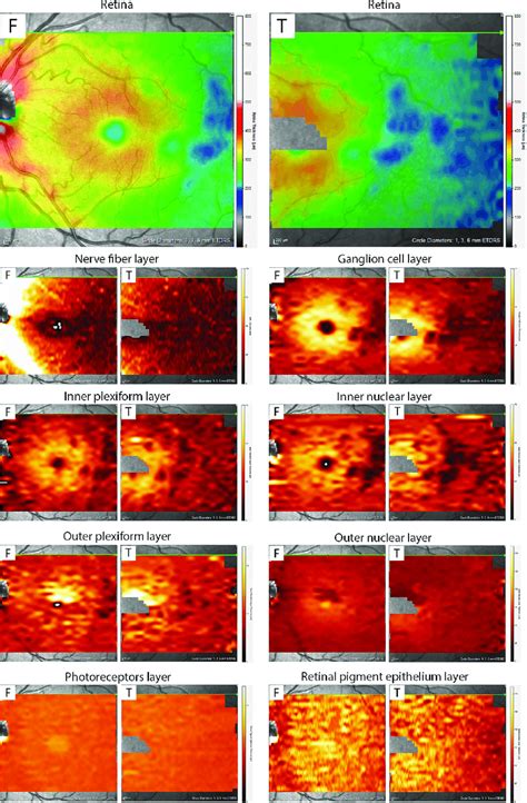 Example Of Individual Retinal Layer Thickness Measurement In Subject Download Scientific