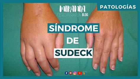 SÍndrome De Sudeck Dsr O Srdc