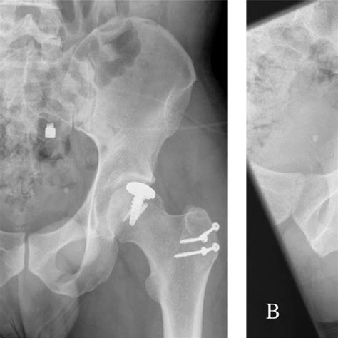 Patient 2 Anterior Obturator Dislocation A And Post Reduction Xr B