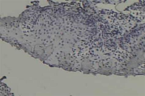 P16 Ihc Staining A Negative P16 Ihc Magnification ×100 B