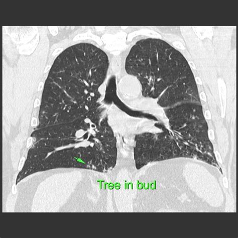 Tree In Bud Opacities Causes Clothed With Authority Online Diary