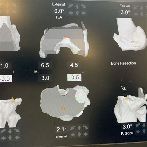 About Robotic Joint Replacement Mtp Health