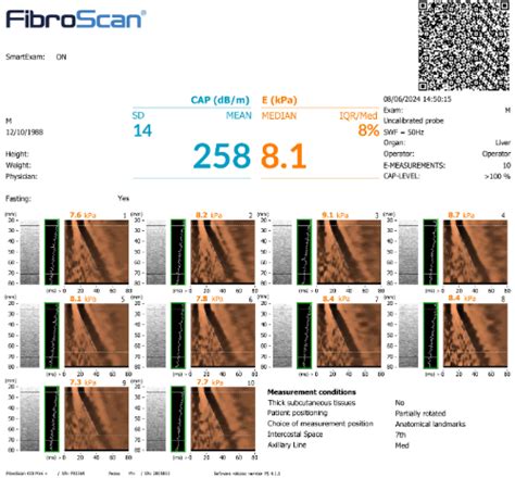 Fibroscan Sachdeva Diagnostics
