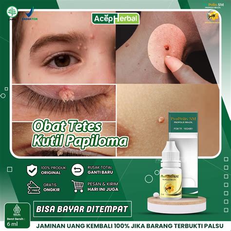 Jual Obat Papiloma Penghilang Papiloma Di Leher Dan Wajah Propolis Sm