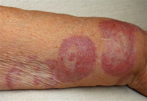 Granuloma Annulare A Rare Skin Disease Stock Image Image Of