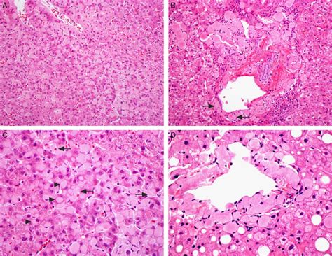 Pathology Pearls Amyloidosis Aasld