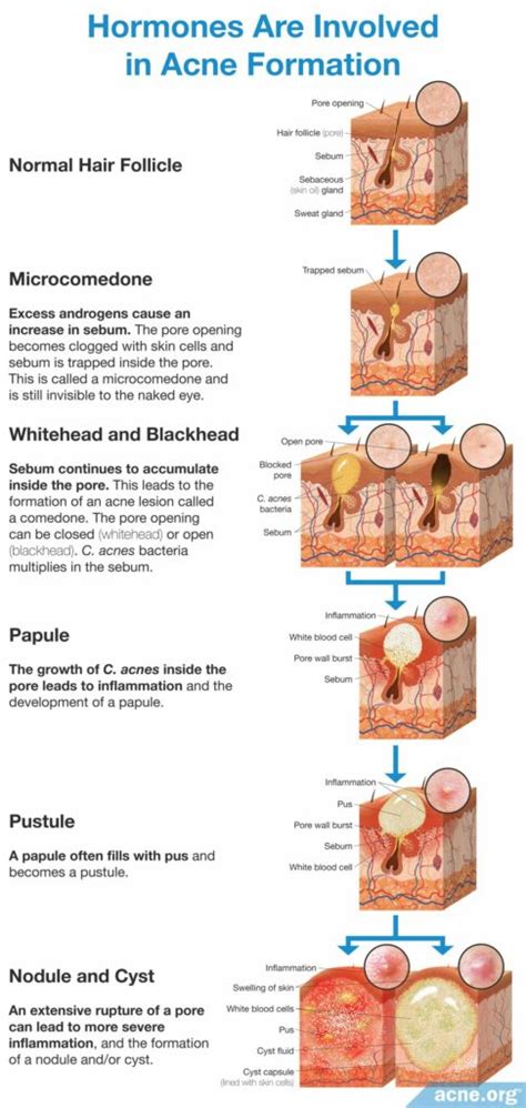 Do Hormones Cause Cystic Acne