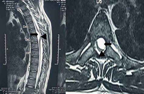 Spinal Arachnoid Cyst