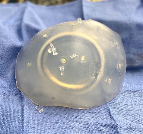 Outer Surface Of Custom Skull Implant With Perfusion Holes Dr Barry