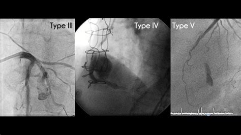 How To Treat Emergency Coronary Perforation