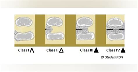 Summary Of Furcation Defects For Dental Hygiene Exams Dentistry Iq