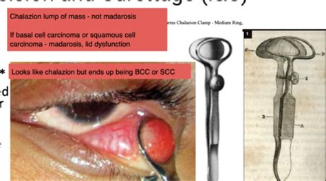 Oc Disease 1 Lecture 8 Infection Bacterial Dacryocystitis Dacryoadenitis Preseptal