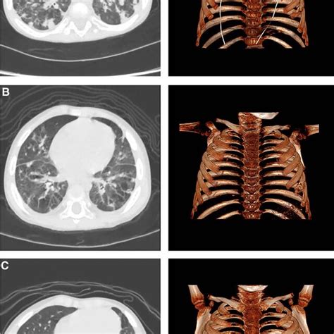 Clinical Features Of Severe Congenital Neutropenia Caused By Elane Gene