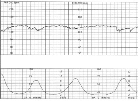 Fetal Monitoring Intermittent Or Continuous Part Two Be Healthy Be