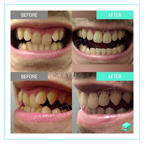 Overbite Wondering If Clear Aligners Could Fix Yours