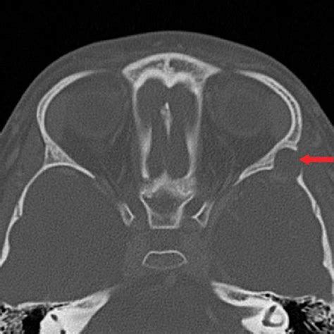 Preoperative Computed Tomography Image Of The Tumor The Lesion Of The