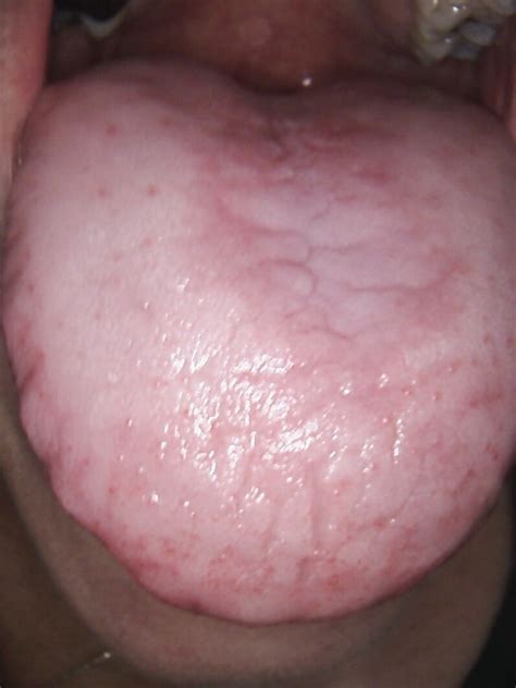Pernicious Anemia Glossitis Exhibiting A Red Smooth Appearance And