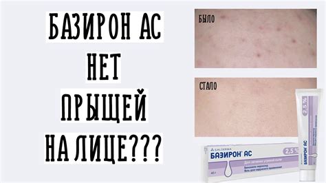 Базирон АС нет прыщей на лице? | Как избавиться от прыщей в домашних ...