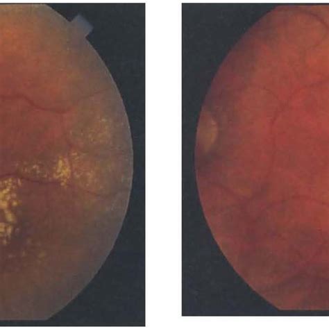 An Exudative Retinal Artery Macroaneurysm Download Scientific Diagram