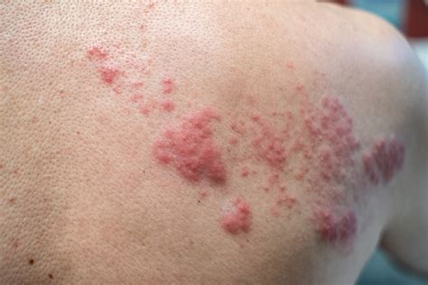 Hives Vs Rash What S The Difference Between Them