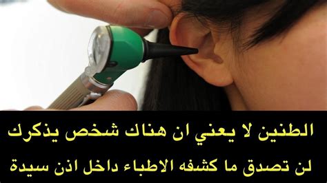 لن تصدقوا ما كشفه الاطباااء داخل اذن احد السيدات Youtube