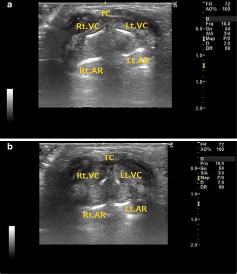 An Example Of Ultrasonographic Assessment Of Vocal Cord Download