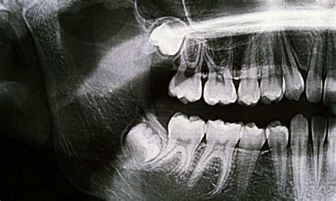 Are Wisdom Teeth On The Top Or Bottom Treating Wisdom Teeth