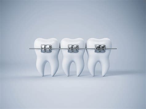 Dental Arch With White Teeth And Braces In 3d Render Royalty Free