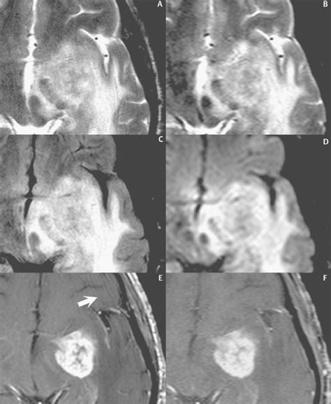 Echo Planar Imaging Radiology Key