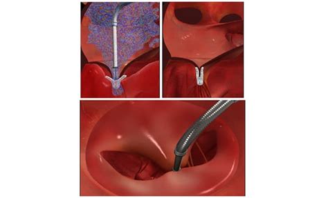 The Mitral Valve Clip The Womens Journal