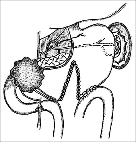 Partial Stomach Partitioning Gastrojejunostomy And The Success Of This Procedure In Terms Of
