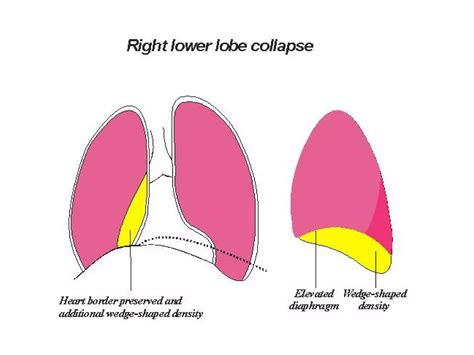 Collapse And Consolidation Lung Radiology Ppt