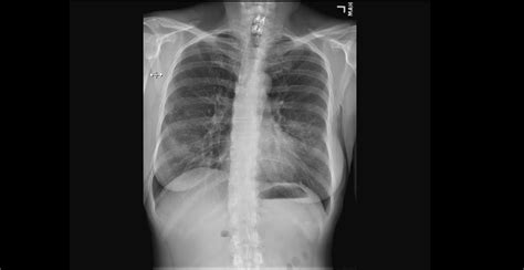 Image Of The Week Persistent Cough And Sputum In A 75 Year Old Woman