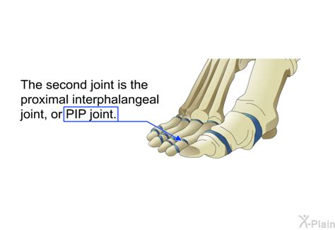 Interphalangeal Joint Toe Toe Joint Deformities