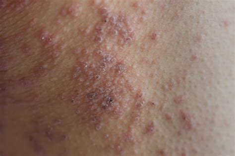 Delving Into Hailey Hailey Disease From Genetics To Triggers Bldg Active