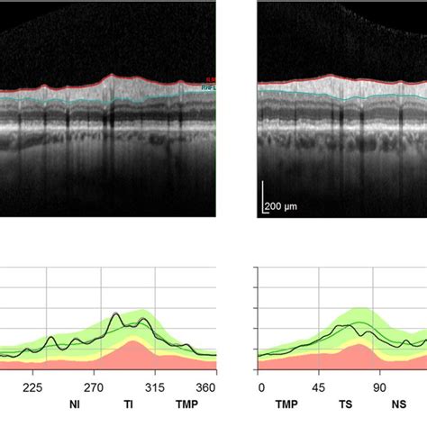 Oct Retinal Nerve Fibre Layer Rnfl Analysis Confirming Mild Download Scientific Diagram