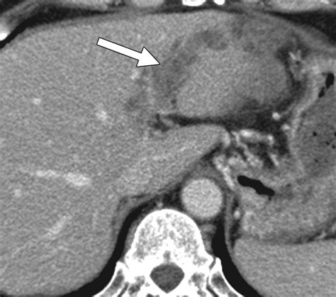 Varying Appearances Of Cholangiocarcinoma Radiologic Pathologic Correlation RadioGraphics