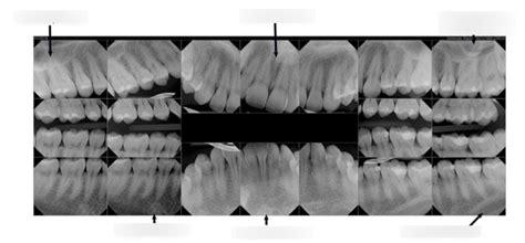 dental radiology fmx