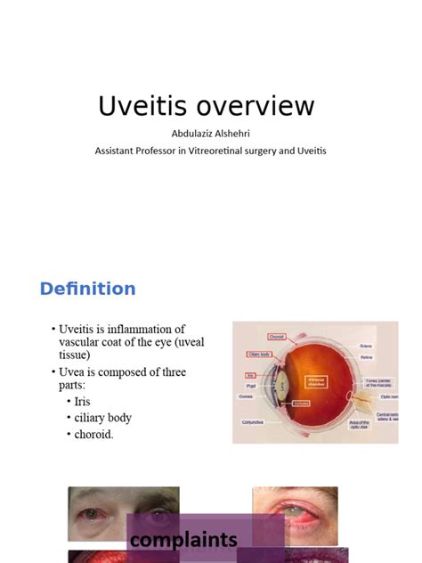 9 Uveitis Overviewpptx Pdf Immunology Human Diseases And Disorders