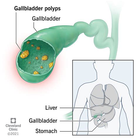 Gallbladder Polyps Symptoms Causes What It Is 43 Off