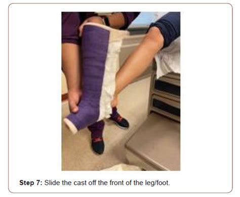 Orthopedic Casting Removal Quick Techniques Iris Publishers