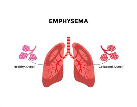 Emphysema Disease Concept Damaged Alveoli Failure Airway Floppy