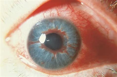 Iris Neovascularization American Academy Of Ophthalmology