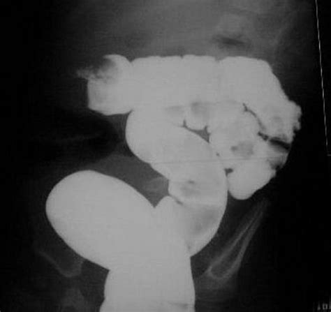 Single And Double Contrast Barium Enema Procedure Indications And Side