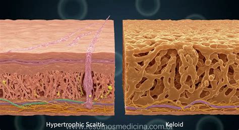 Queloides Vs Cicatrizes Hipertróficas Guia Completo Para Diferenciar Prevenir E Tratar