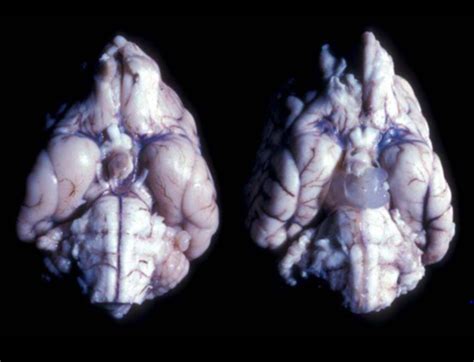Endocrine Pathology Flashcards Quizlet