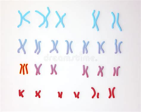 Patau Syndrome Karyotype Stock Illustration Illustration Of Human