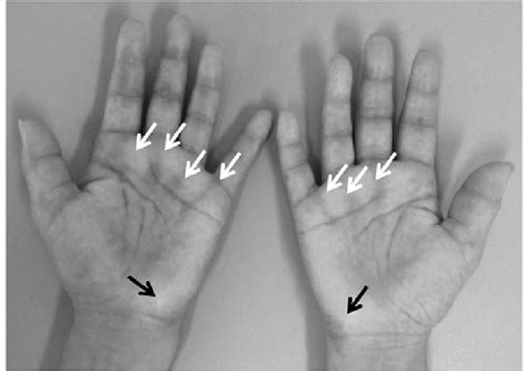 Palmar Aspects Of Edema Surrounding The Elastic Hard Nodule White Download Scientific Diagram