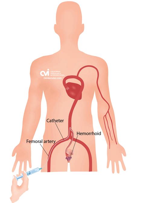 Hemorrhoid Embolization Treatment Top Doctor Ca Center